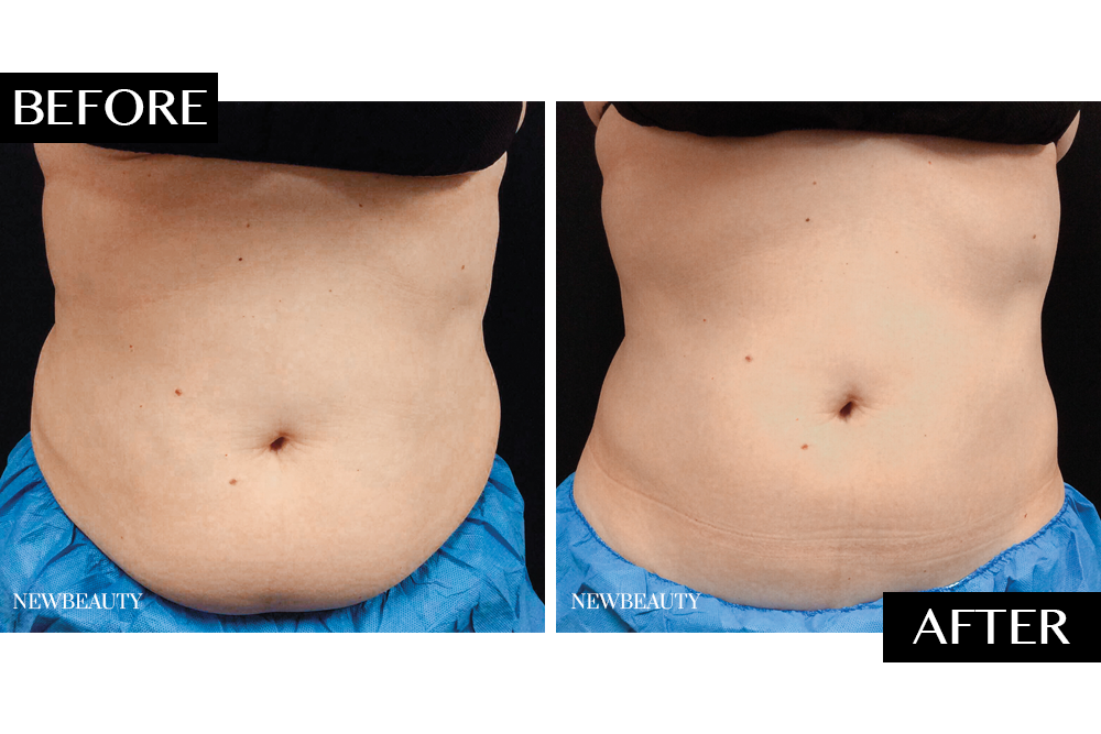 Coolsculpting Ideal Image Stomach Review Newbeauty