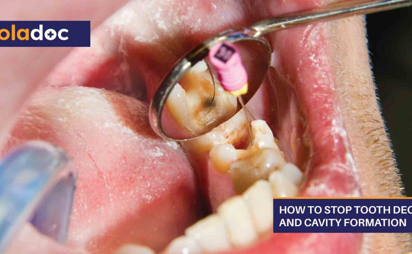 How To Stop Tooth Decay And Cavity Formation Teeth And Gums