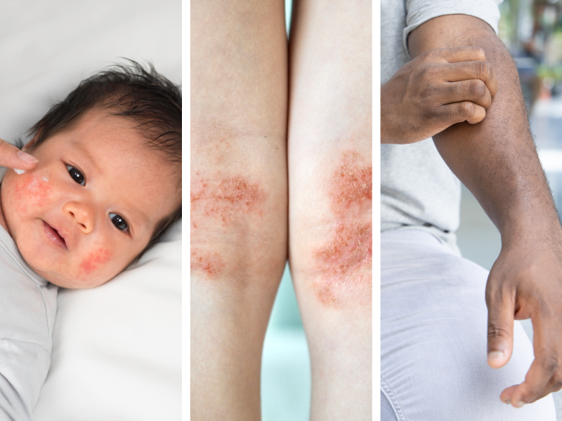 Optimal Management Of Moderate To Severe Atopic Dermatitis Infants