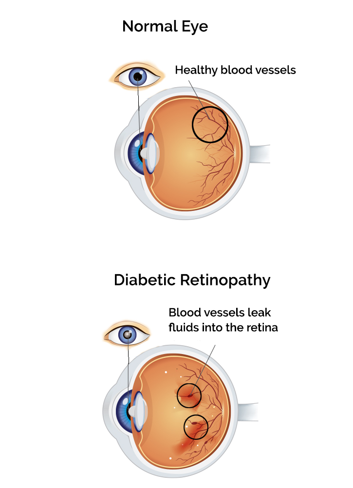 Diabetic Retinopathy Diabetes Eye Exam In Erie