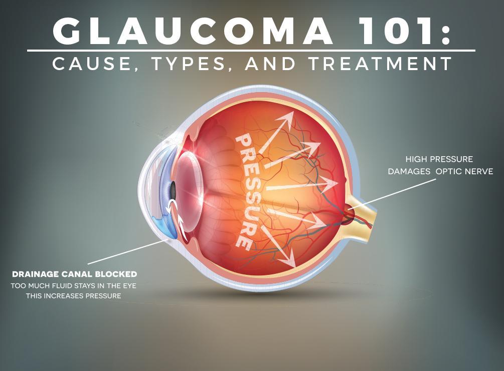 Glaucoma 101 Cause Types And Treatment