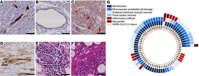 Jci Insight Clinico Histopathologic And Single Nuclei Rna Sequencing