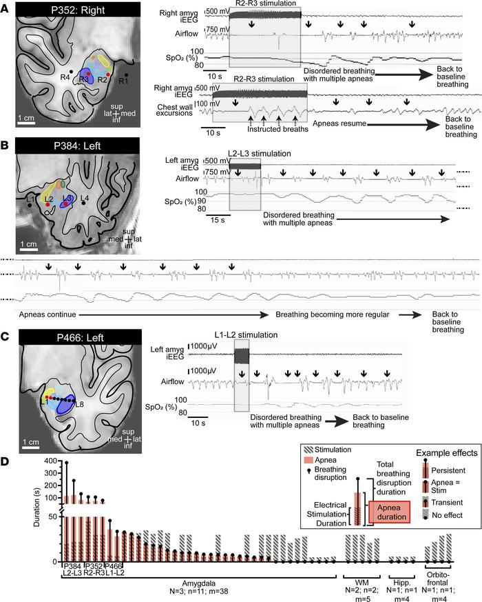 Jci Insight Failure To Breathe Persists Without Air Hunger Or Alarm