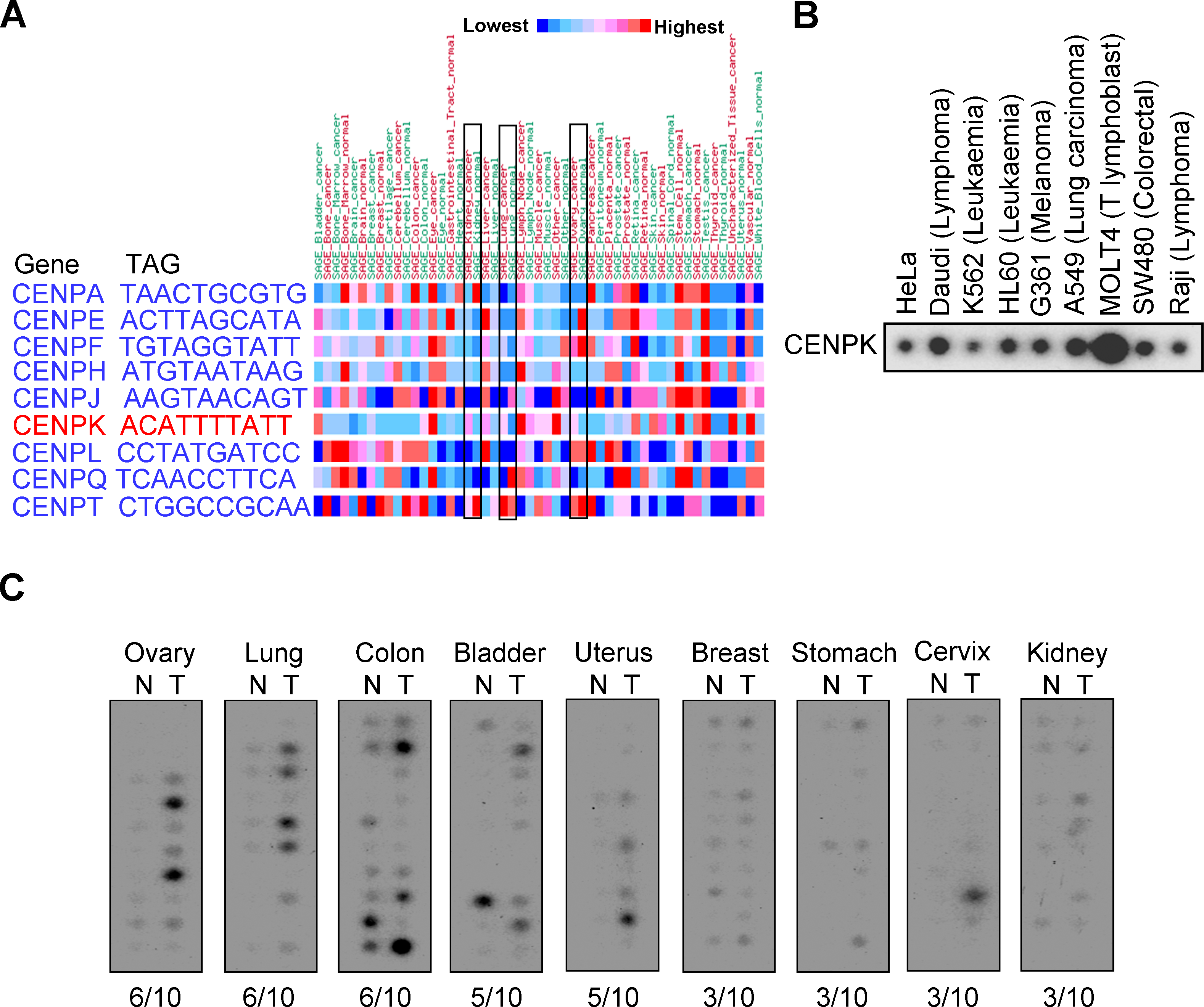 Overexpression Of Centromere Protein K Cenpk In Ovarian Cancer Is