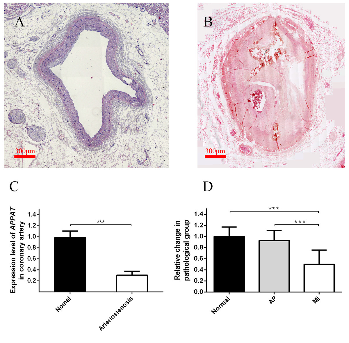 Expression Status And Clinical Significance Of Lncrna Appat In The