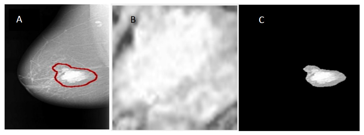 Breast Cancer Detection Using Deep Convolutional Neural Networks And