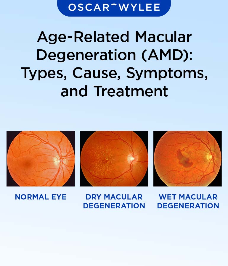 Age Related Macular Degeneration Amd Types Cause Symptoms And