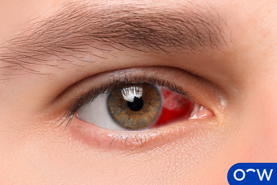 Eye Bleeding Hyphema Definition Causes Symptoms Risk Factor And