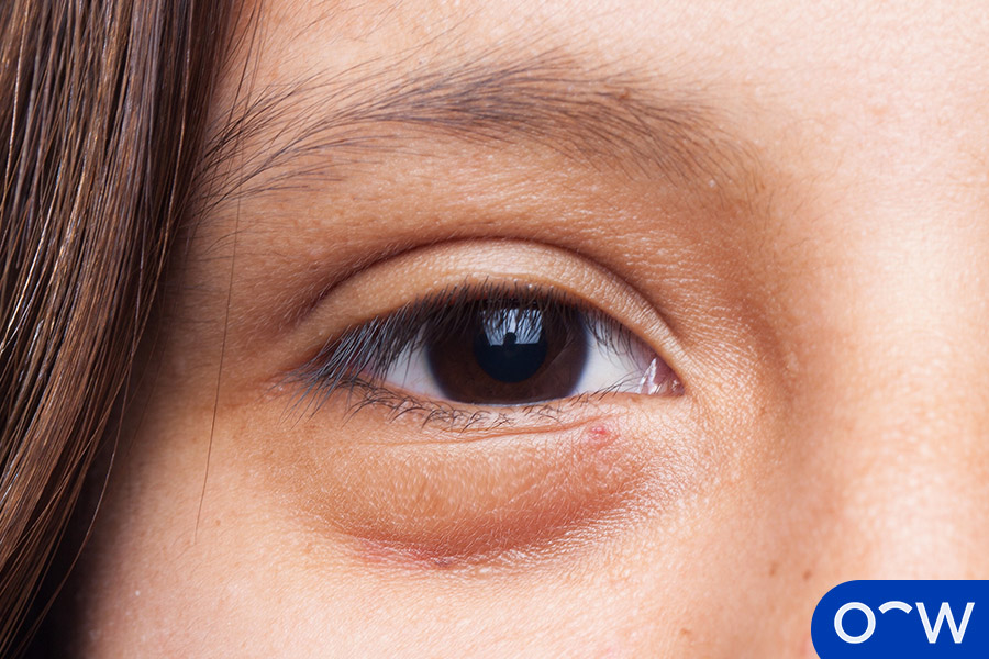 Puffy Eyes Definition Causes Symptoms And Treatment