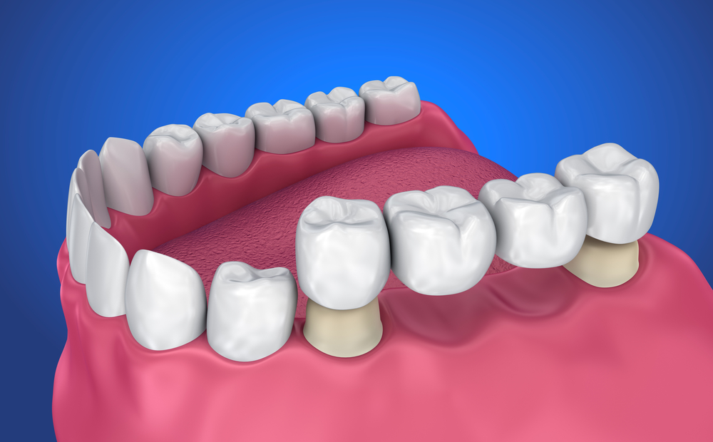 Porcelain Fixed Bridges Desert Dental Spa