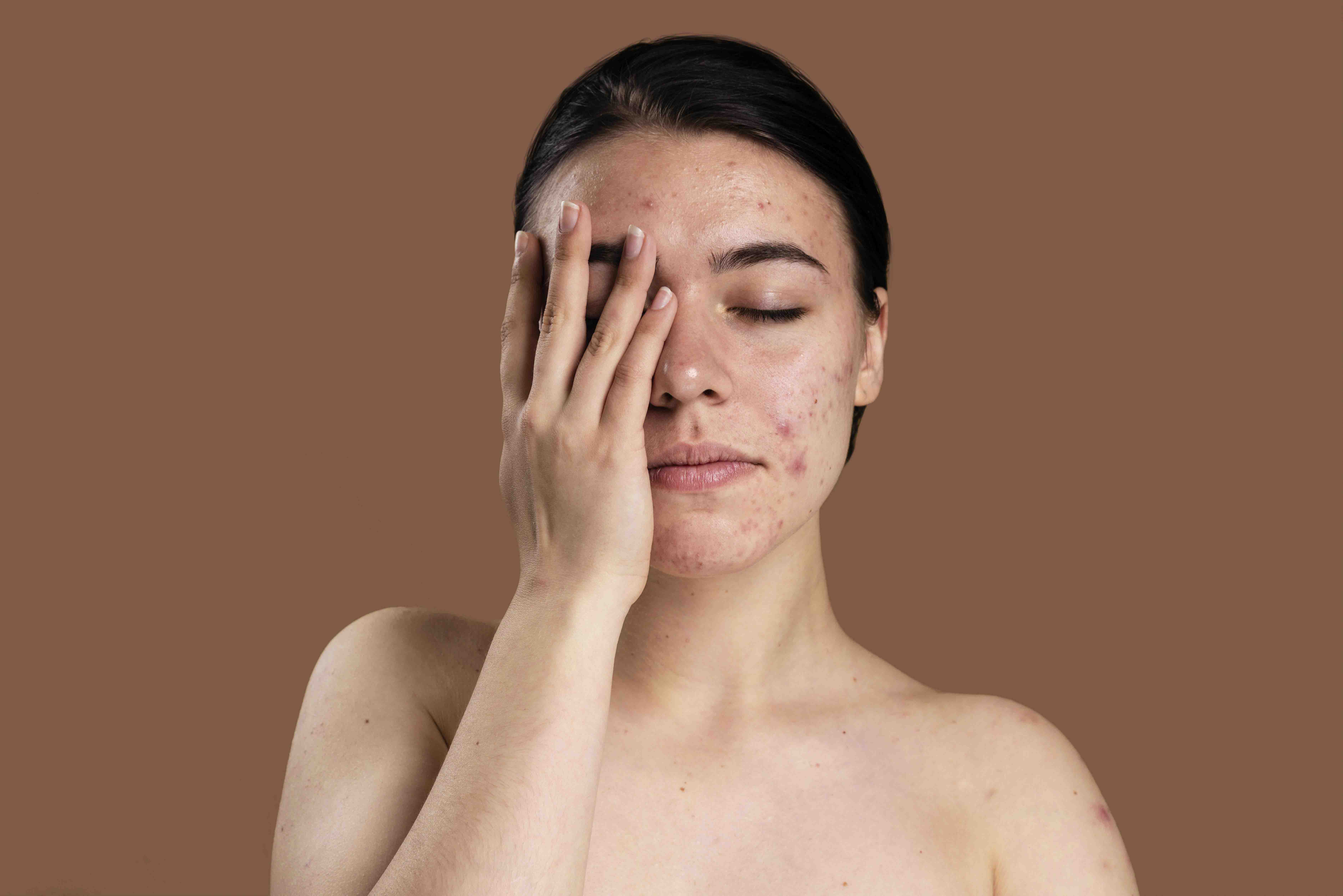 Hermina Hospitals What Is Acne Causes And How To Prevent Acne