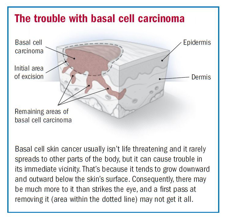 Basal Cell Carcinoma Overview Harvard Health