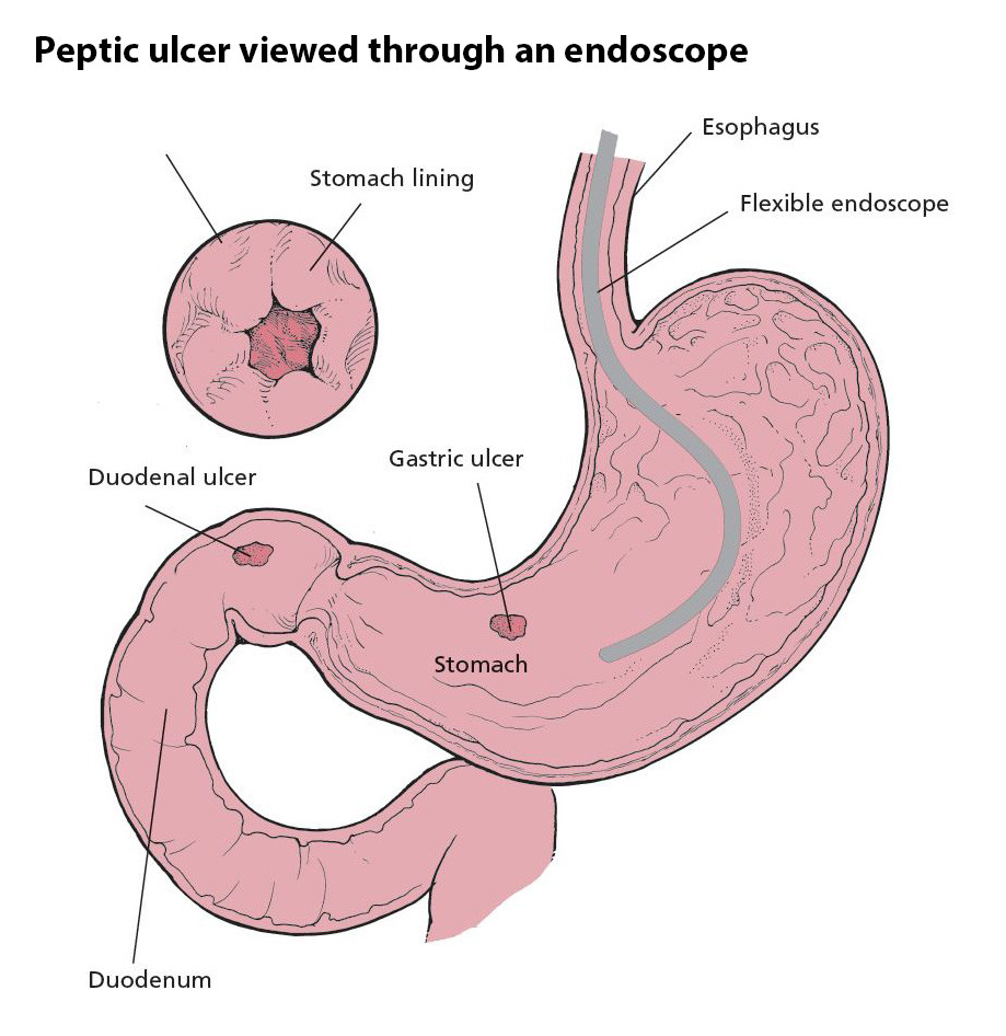 Peptic Ulcer Harvard Health