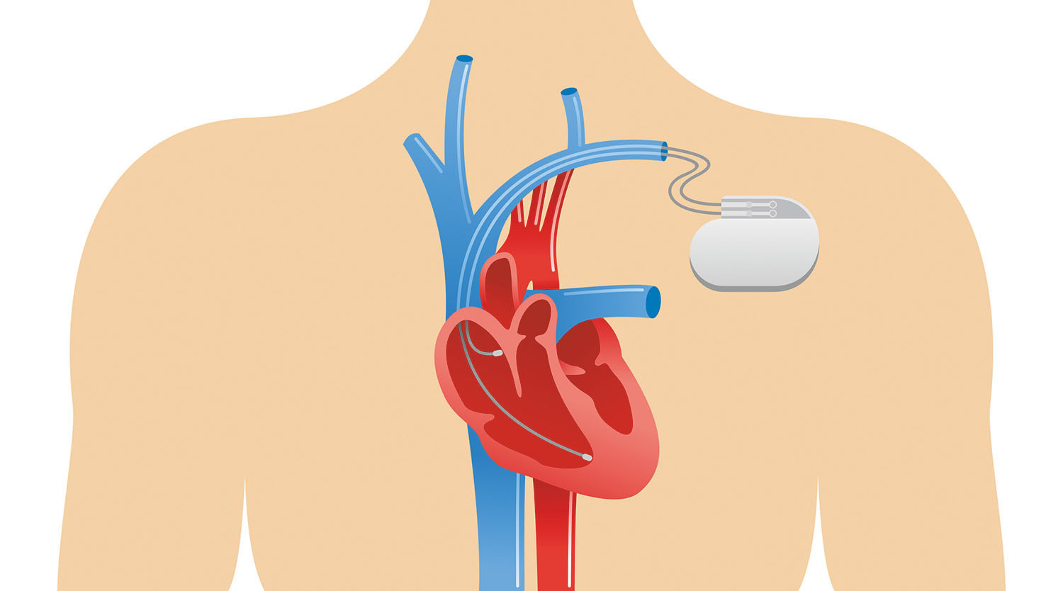 The Inside Story On Pacemakers Harvard Health