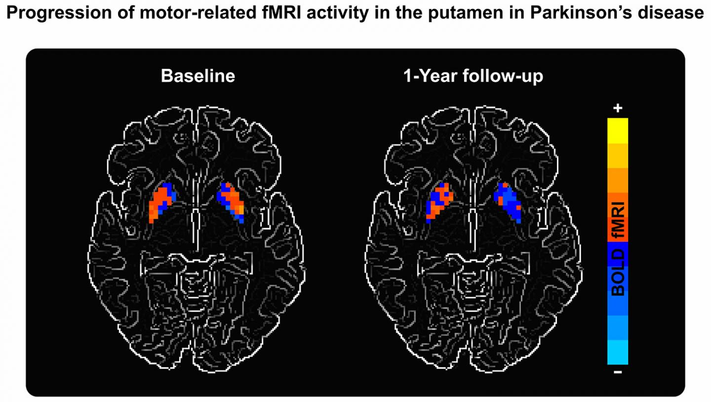 Biomarker Breakthrough Could Improve Parkinsons Treatment