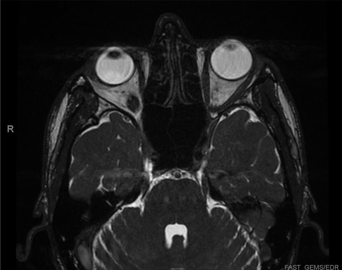 Microvascular Decompression And Radiofrequency Lesioning For Trigeminal