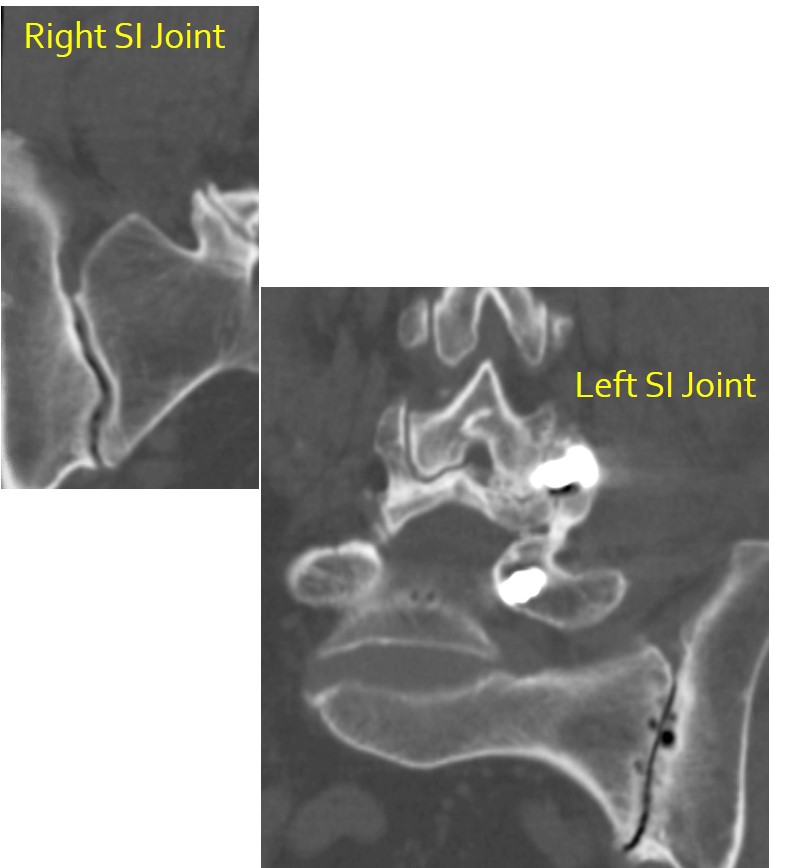 Sacroiliac Si Joint Fusion For Sacroiliac Degenerative Disease