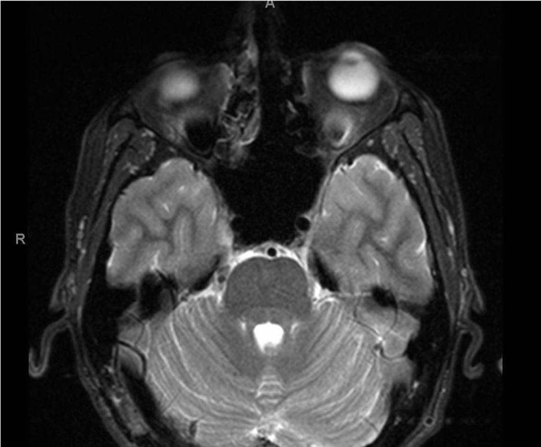 Microvascular Decompression And Radiofrequency Lesioning For Trigeminal