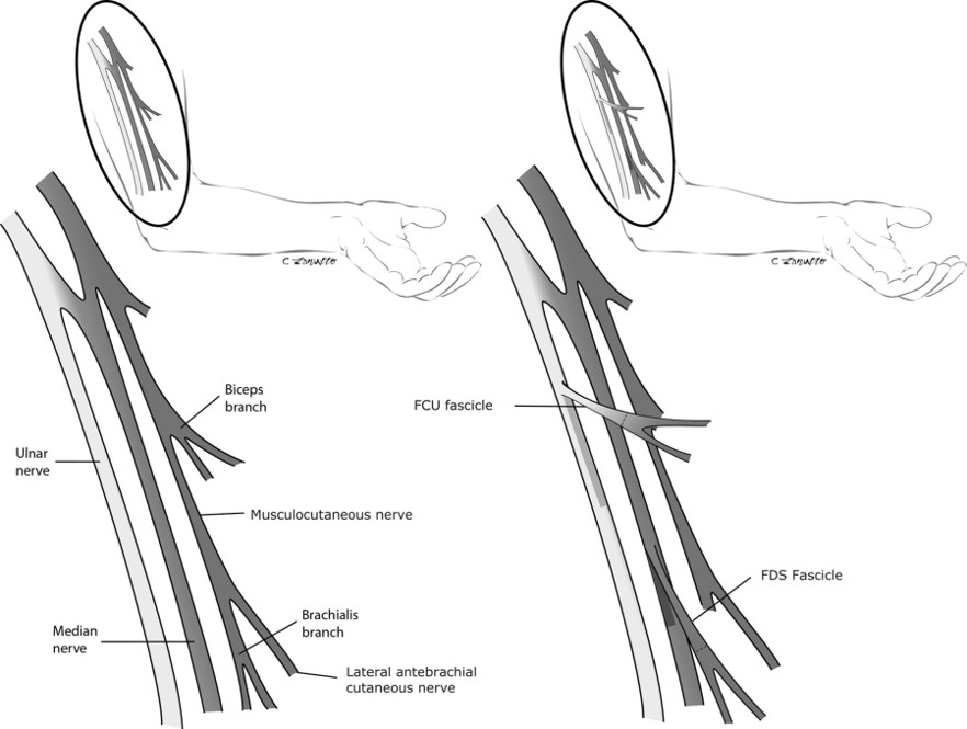 Upper Extremity Nerve Transfer For Brachial Plexus Injury