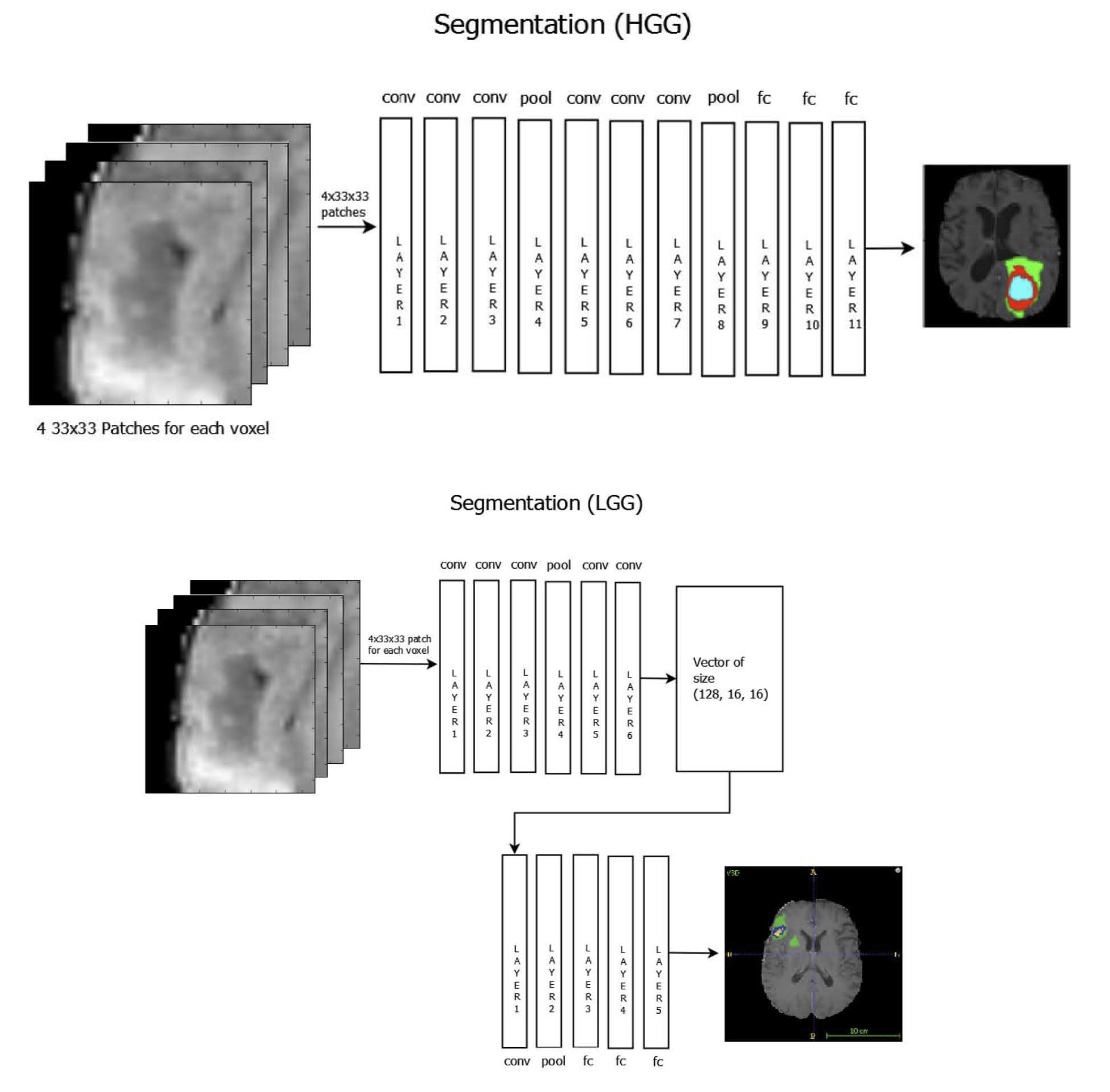 Cnn For Brain Tumor Segmentation Intel Devmesh