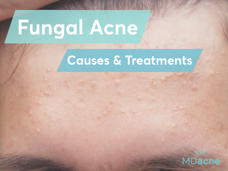 Fungal Acne Causes And Treatments Mdacne