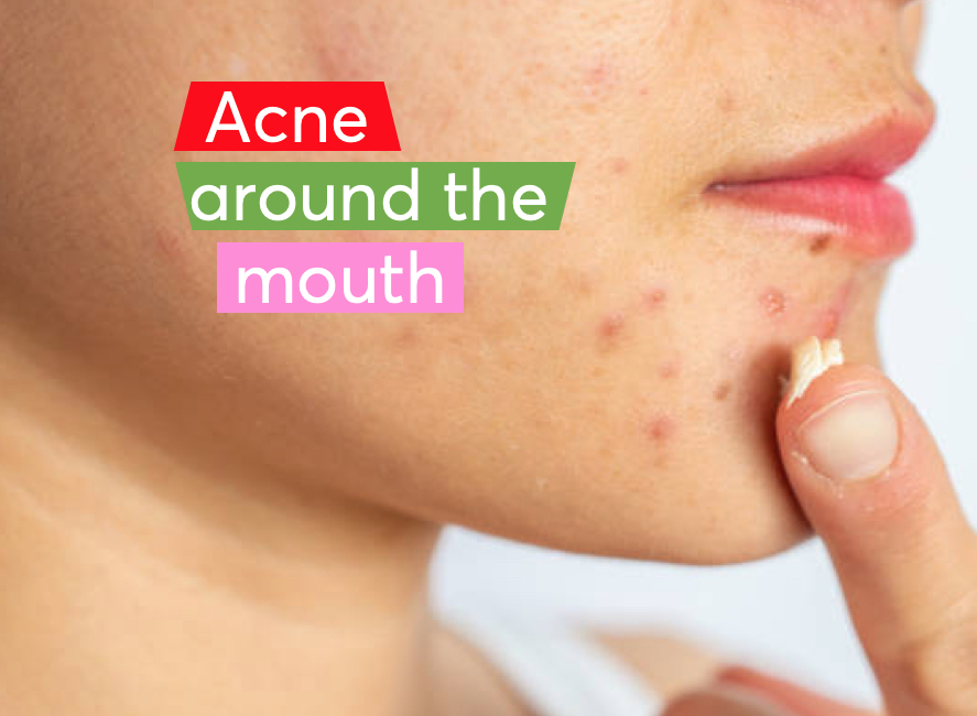 Acne Around The Mouth Mdacne