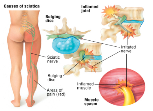 Sciatica And Non Surgical Spinal Decompression Therapy Integrated