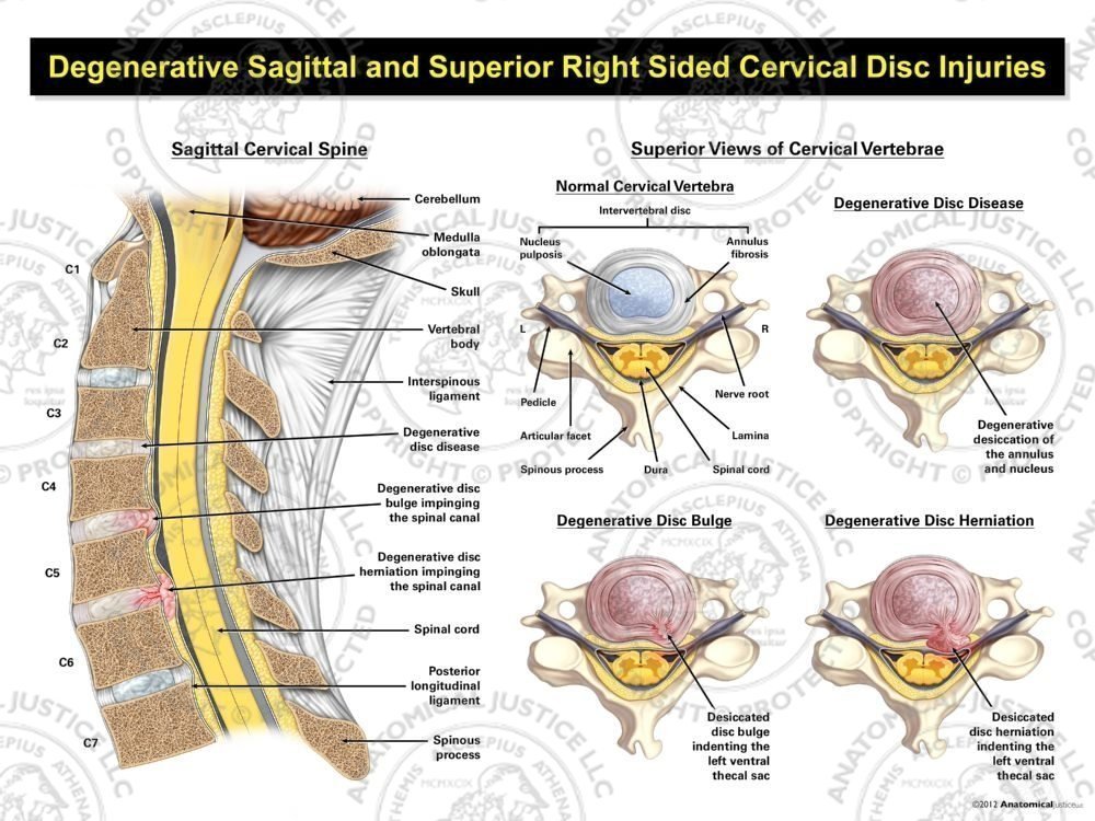 Cervical Degenerative Disc Disease With Right Disc Injuries