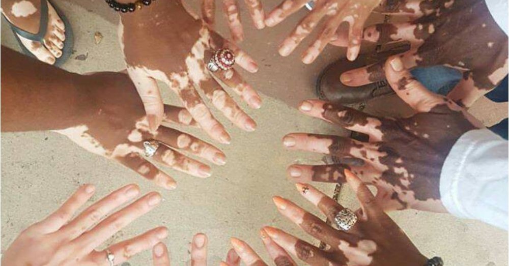 World Vitiligo Day 2019 Focuses On Psychological Well Being Youth Ki