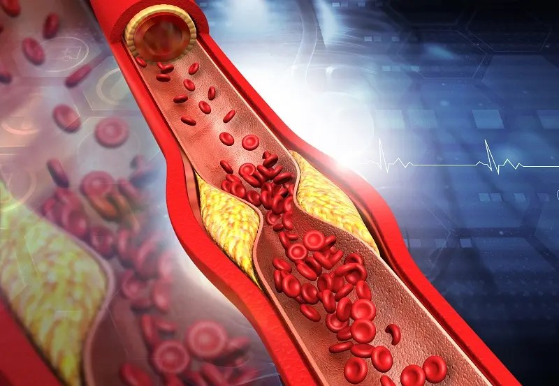 How Doctors Treat Clogged Arteries Without Surgery 247 Wellness Tips