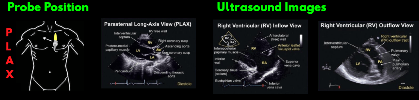 Parasternal Long Axis Plax Critical Care Northampton