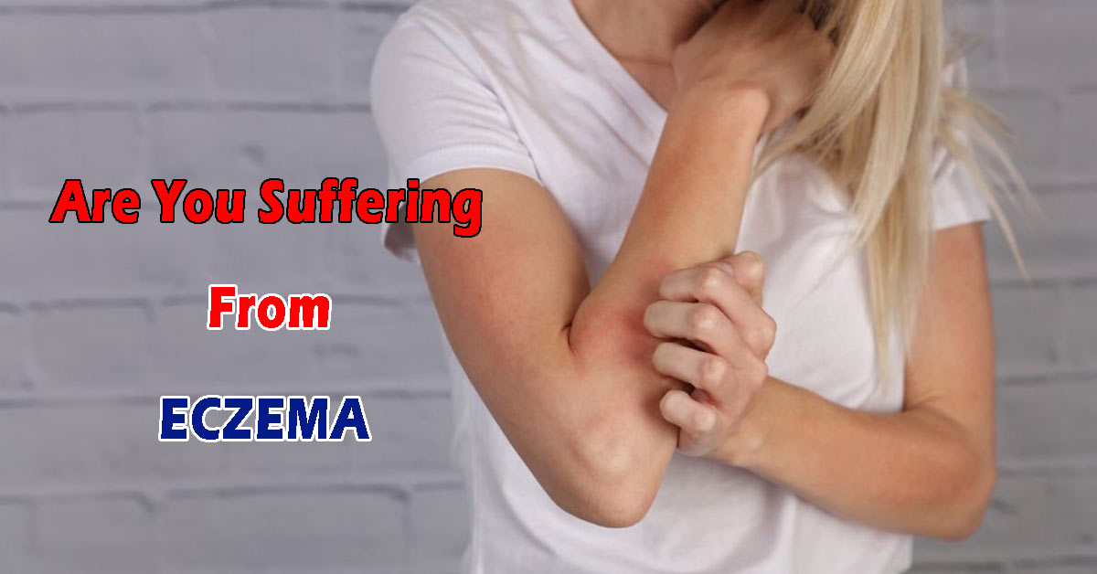 How To Cure Eczema Permanently How To Treat Eczema Naturally