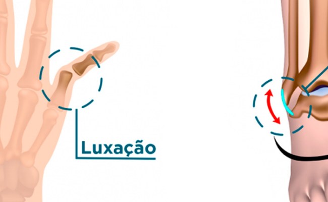 A Diferenca Entre Fratura Luxacao Contusao E Entorse Otosection