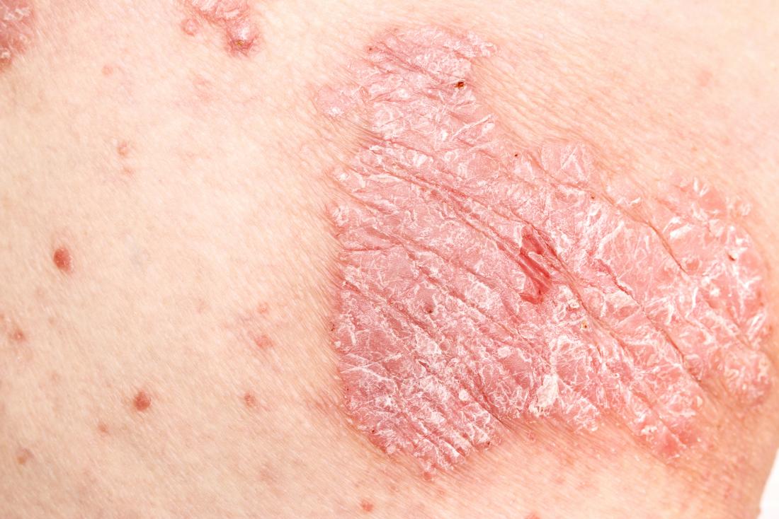 Genital Psoriasis Symptoms Treatment And Causes 2023