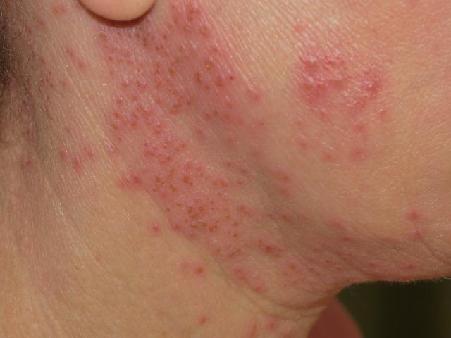 Treatment For Herpes Simplex On Face Tratament