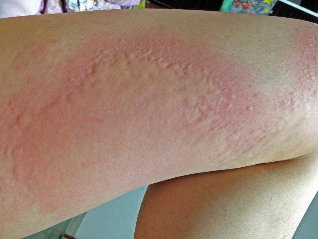 Itchy Raised Skin Bumps On Legs