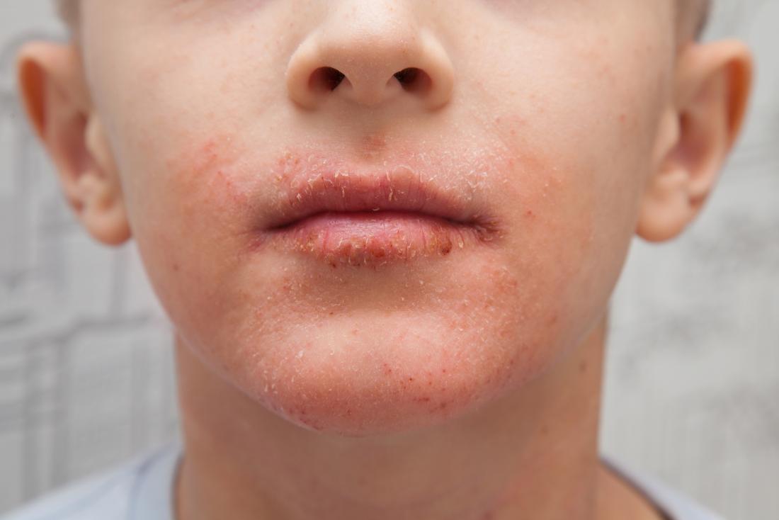 Dry Skin Rash On Face