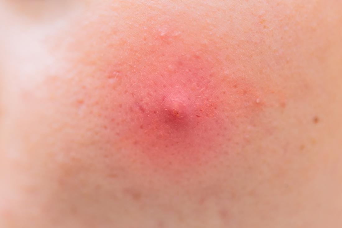 Armpit Pimple Types Causes And Treatments