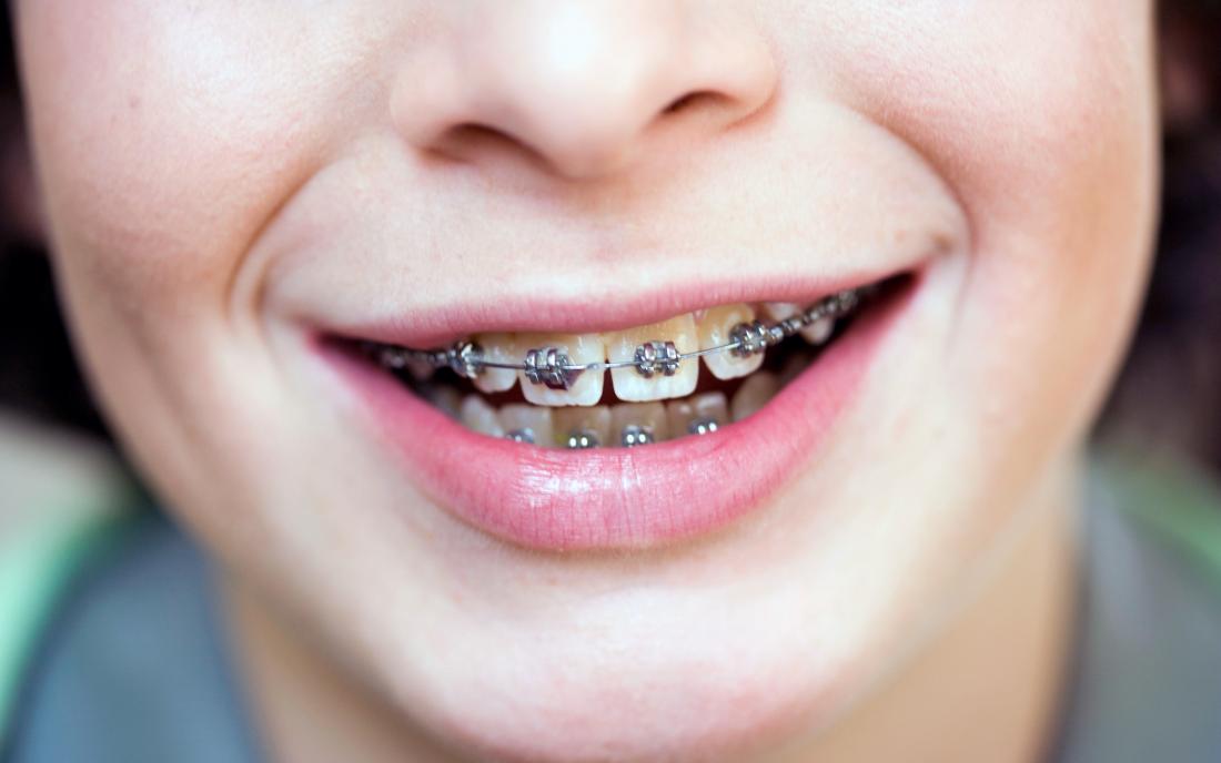 Do Braces Hurt What To Expect When You Get Braces