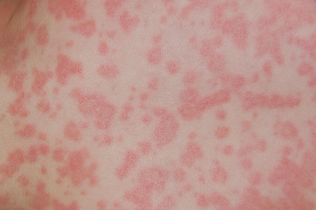 Antibiotic Rash