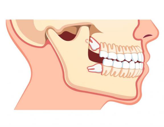 Wisdom Teeth Clinica Dental Tenerife Sur