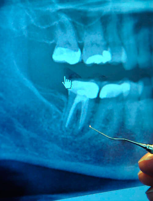 Endodontics Clinica Dental Tenerife Sur