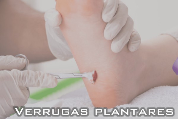 Verrugas Plantares Clinica La Caridad