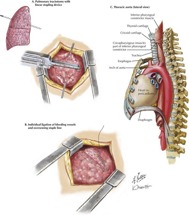 Emergency Thoracotomy For Trauma Clinical Gate