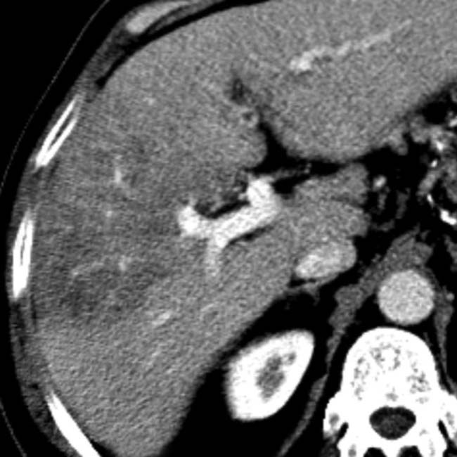 Radiation Induced Liver Disease Clinical Gate