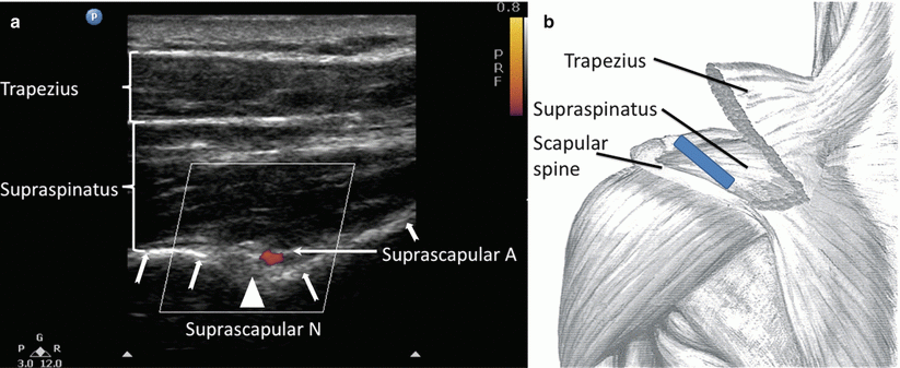 Suprascapular Nerve Block Anesthesia Key