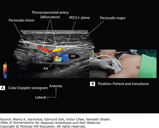 Sonoanatomy Relevant For Thoracic Interfascial Nerve Blocks Pectoral