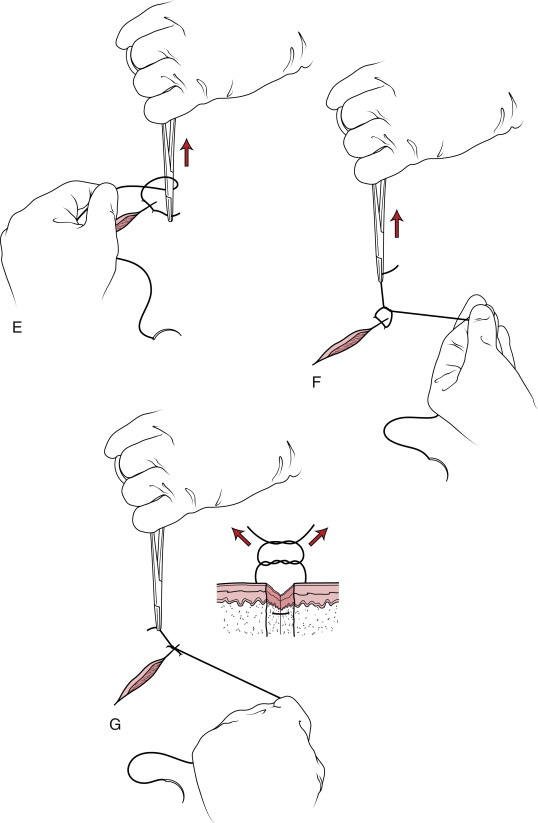 Basic Laceration Repair Principles And Techniques Anesthesia Key