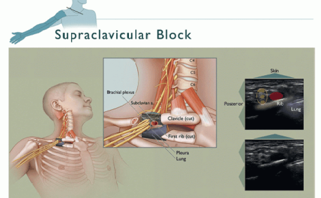 Ultrasound Guided Brachial Plexus Block Supraclavicular Approach