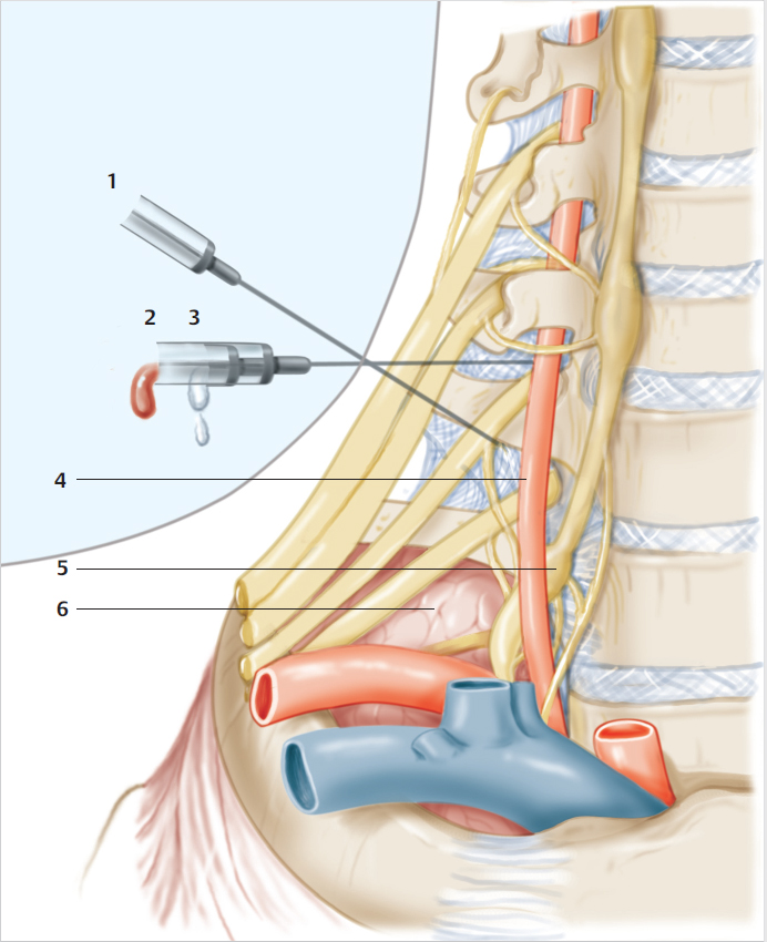 3 Interscalene Techniques Of Brachial Plexus Block Anesthesia Key